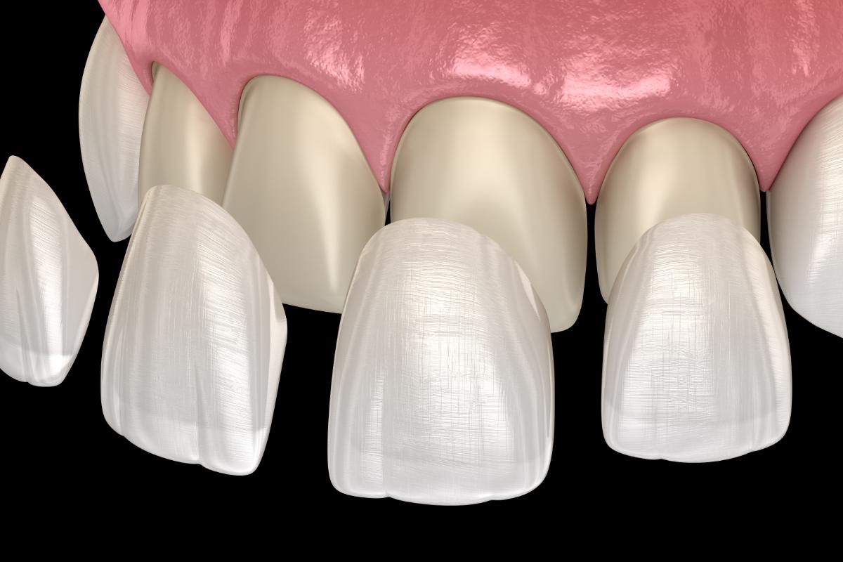 5 Benefits Of Dental Veneers Texas Cosmetic Dentistry